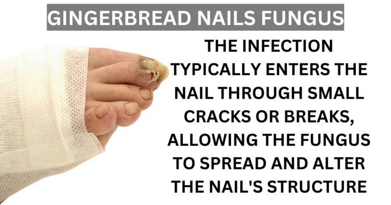 Gingerbread Nails Disease Pictures, symptoms & treatment